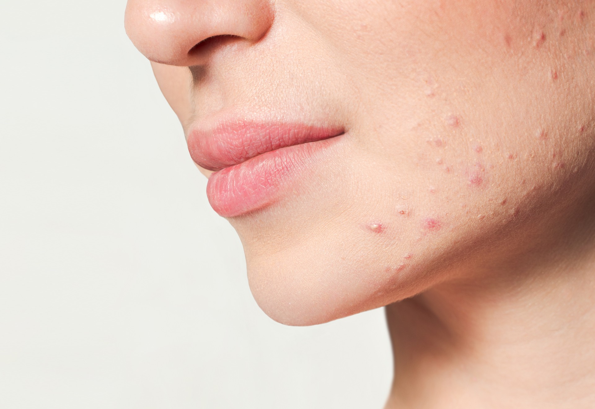 Tratamiento Antiacné y Poros Dilatados en Torrelavega | Estética Rosi